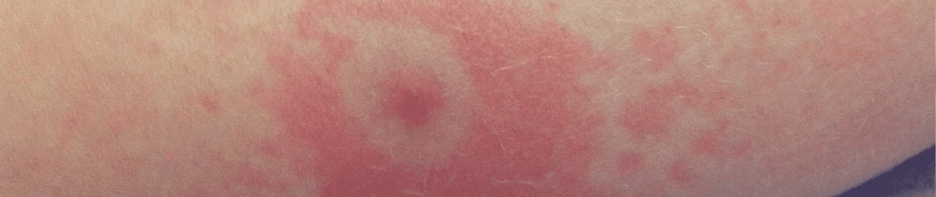 The characteristic bullseye rash for Lyme disease | Innatoss